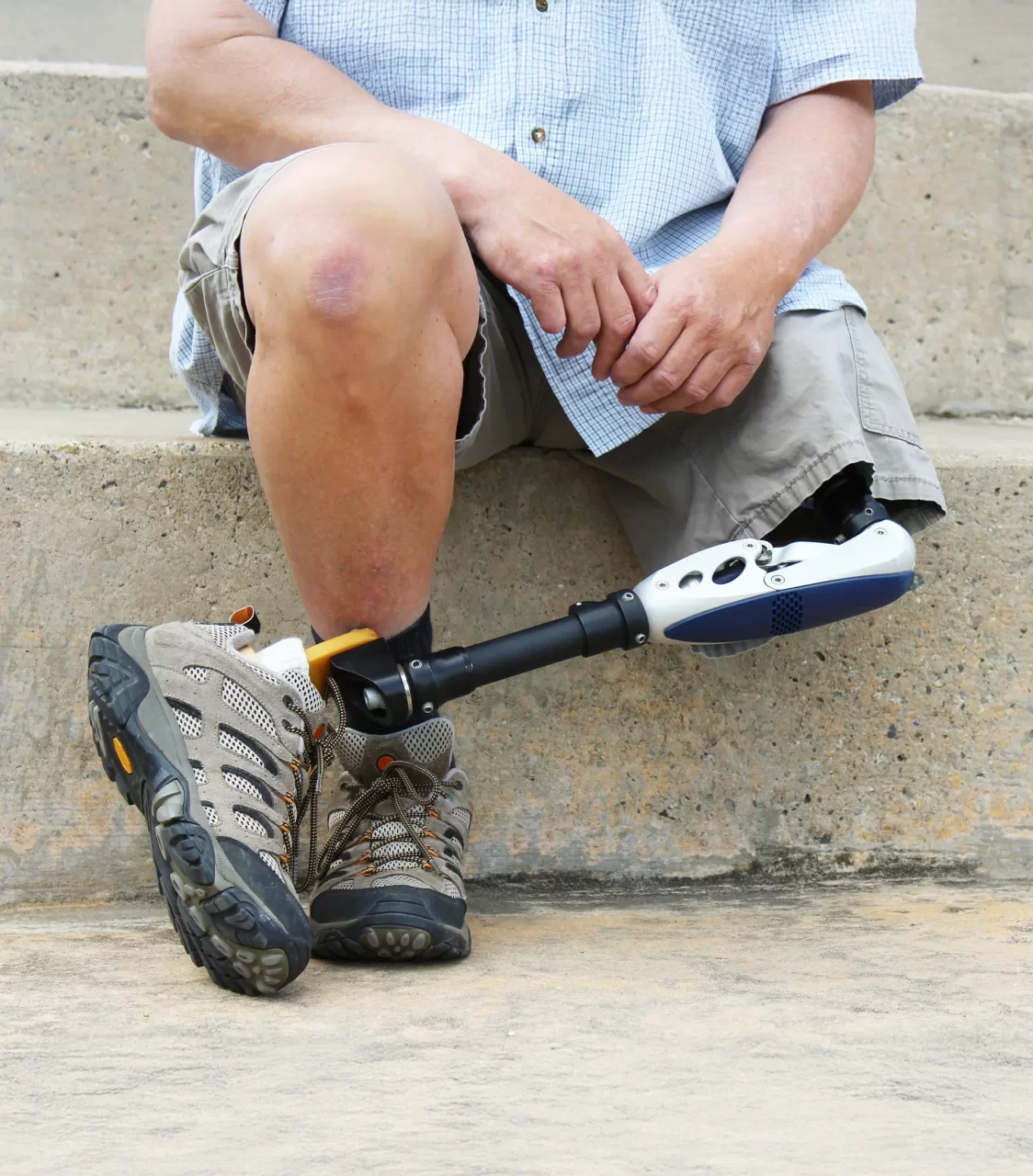 Amputation Injury Lawyer | Braithwaite Boyle